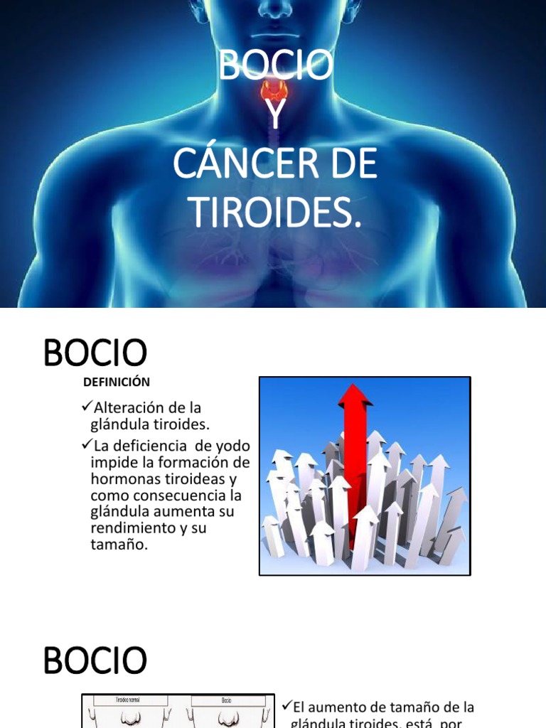 Bocio y Cáncer Tiroideo. | Tiroides | Hipotiroidismo