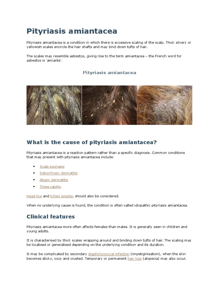 Pityriasis Amiantacea | PDF | Psoriasis | Dermatitis