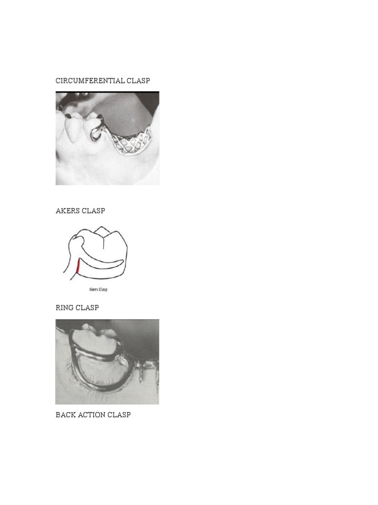 RPD Clasps 1 | PDF
