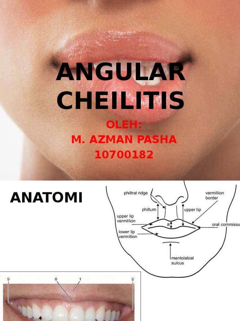 Angular Cheilitis | PDF