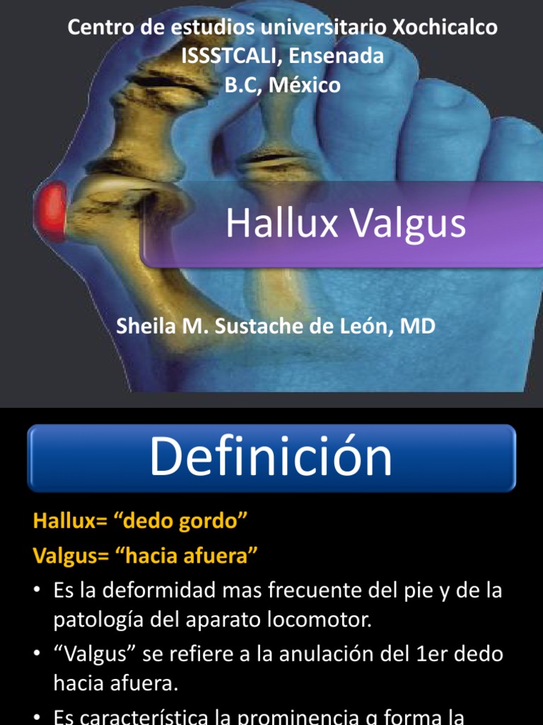 Hallux Valgus Interfalángico: Definición y Características | PDF | Dedo ...