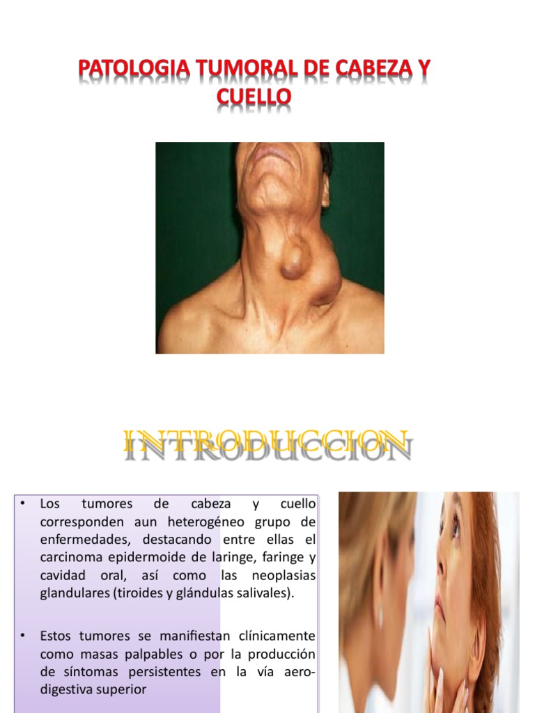 Tumores de Cabeza y Cuello A | PDF | Cáncer | Metástasis