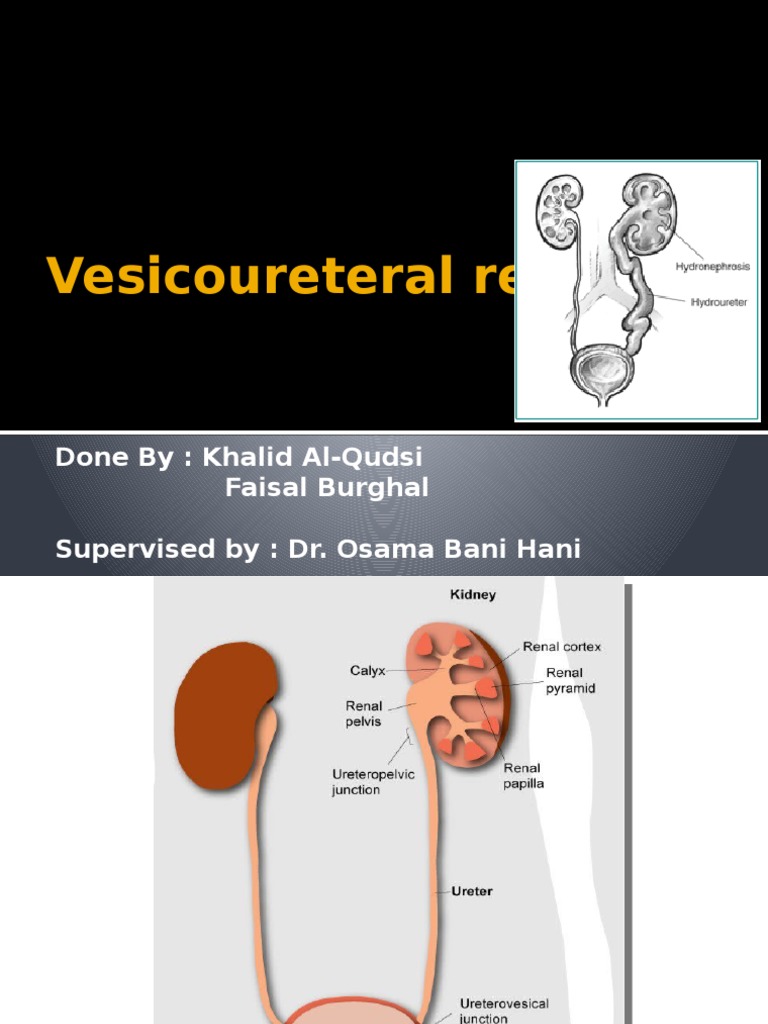22 - Vesicoureteral Reflux | PDF | Surgical Specialties | Medical ...