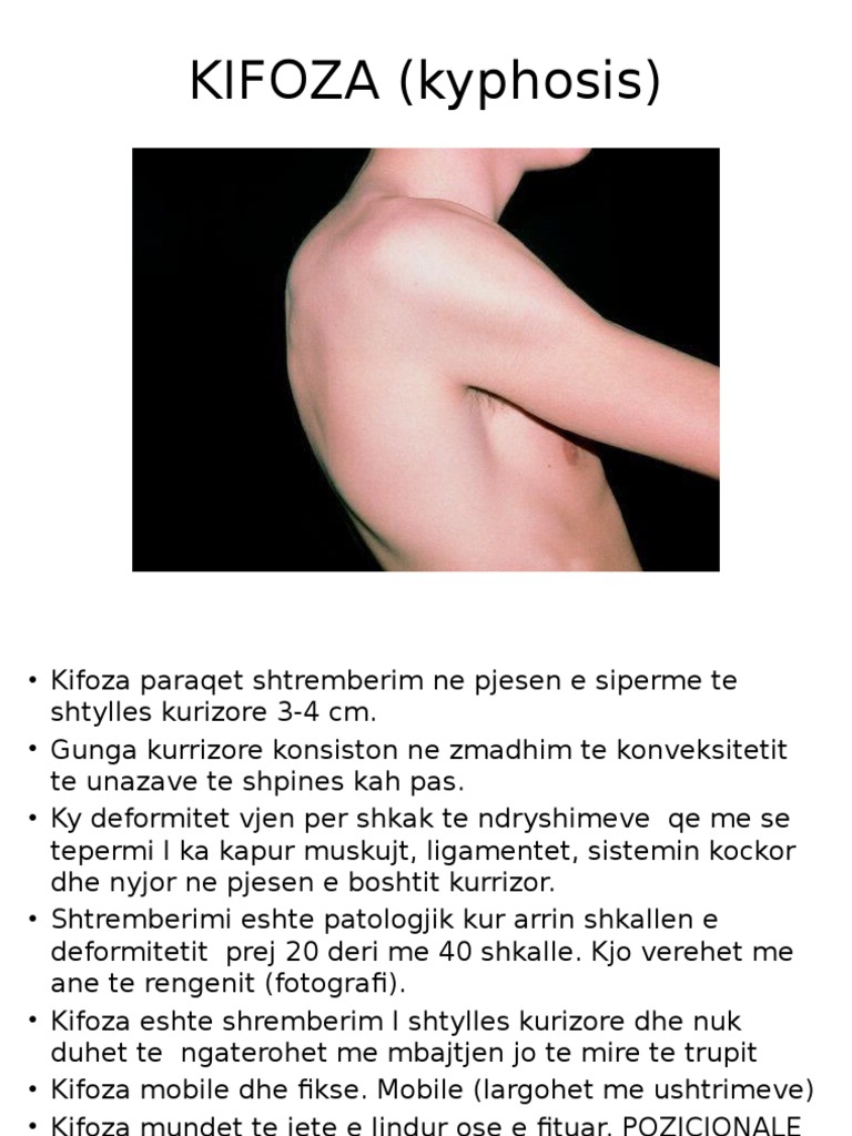 KIFOZA (Kyphosis) | PDF