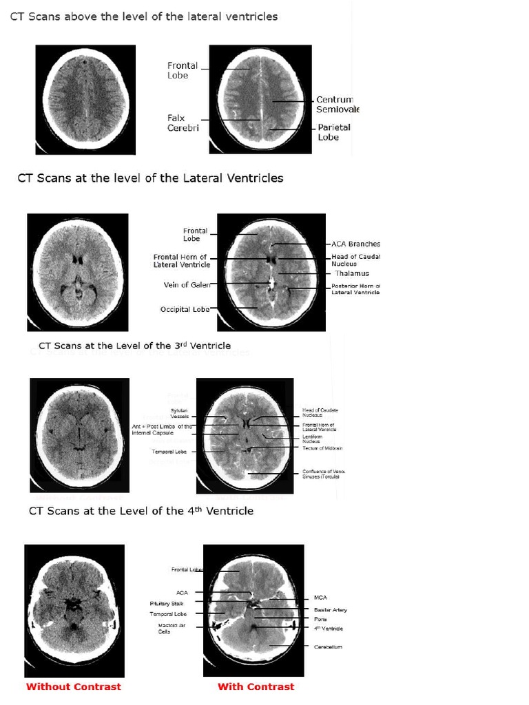 Normal CT Brain | PDF