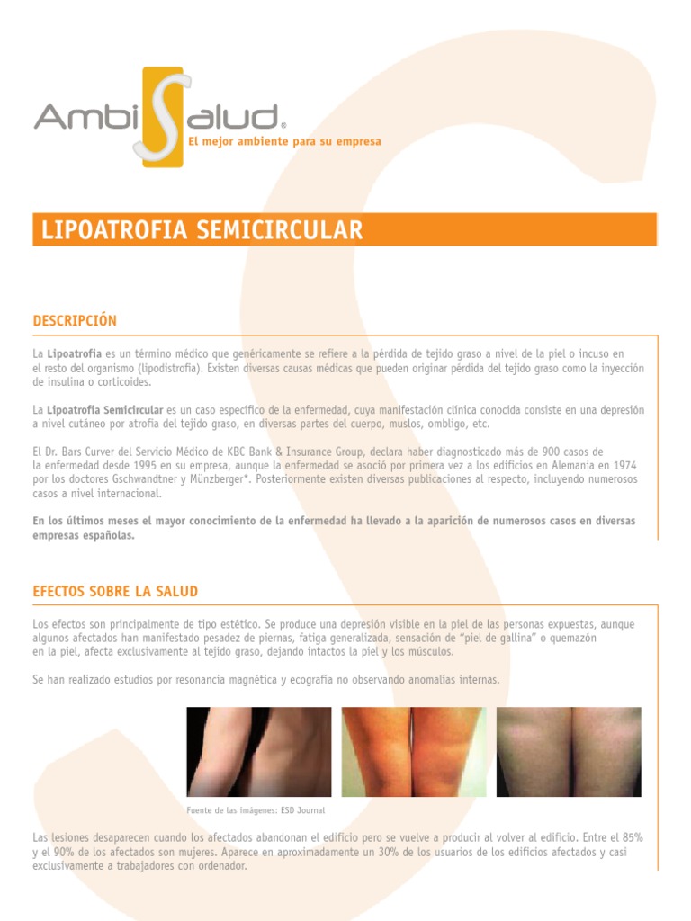 Lipoatrofia Semicircular: Causas y Tratamiento | PDF | Tejido adiposo ...