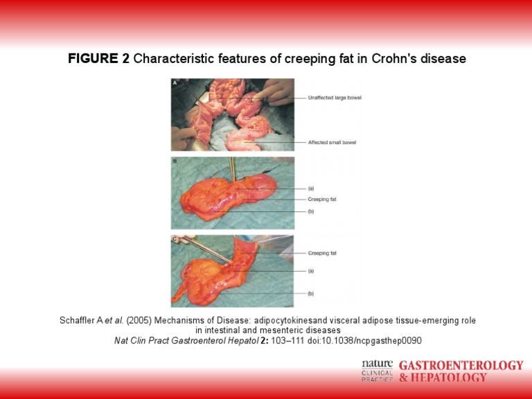 Creeping Fat in Crohn's Disease | PDF