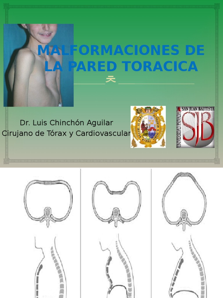 Malformaciones de La Pared Toracica | Tórax | Especialidades médicas