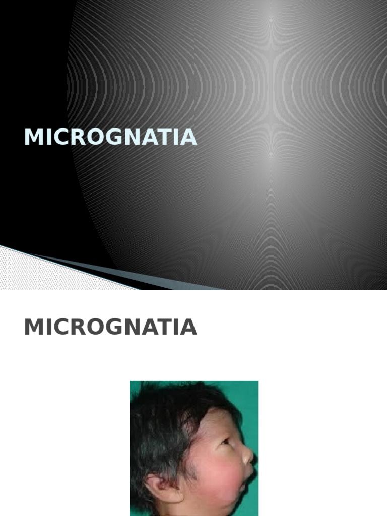 Micrognatia: Definición y Tratamiento | PDF