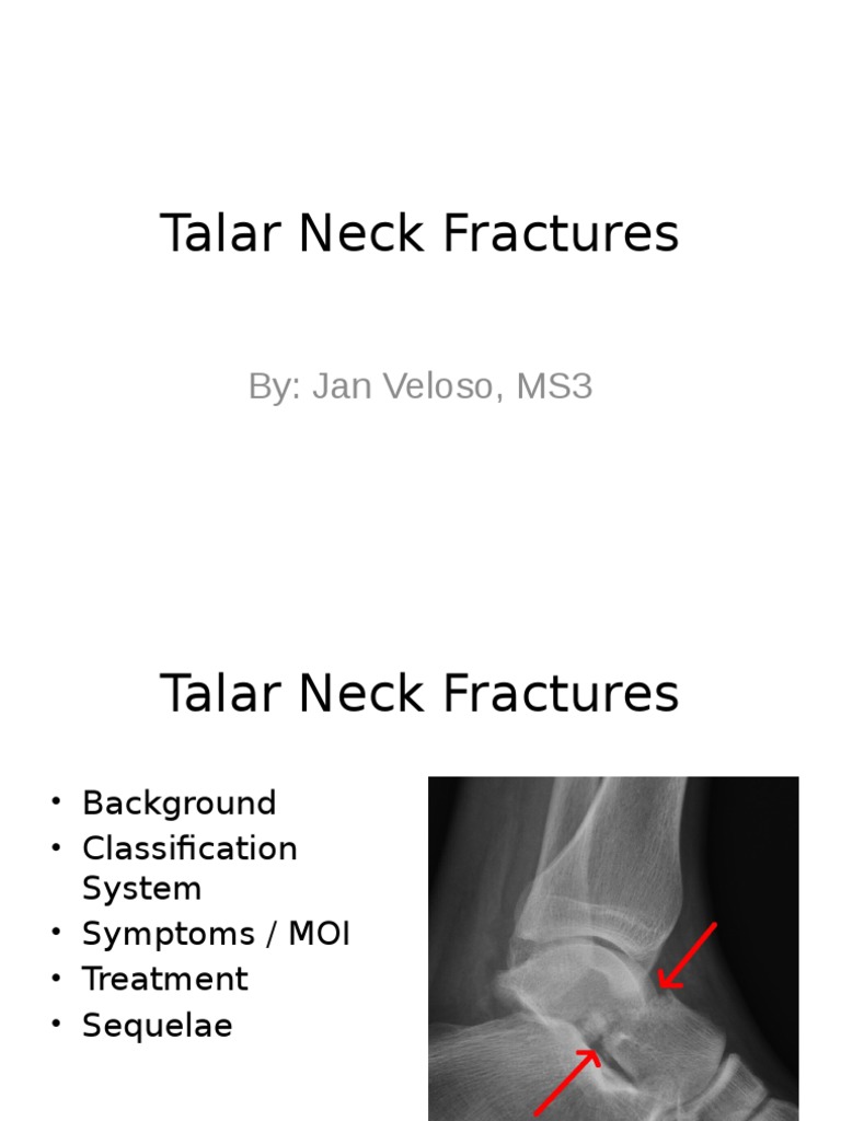 Talar Neck Fractures Presentation | PDF | Ankle | Lower Limb Anatomy