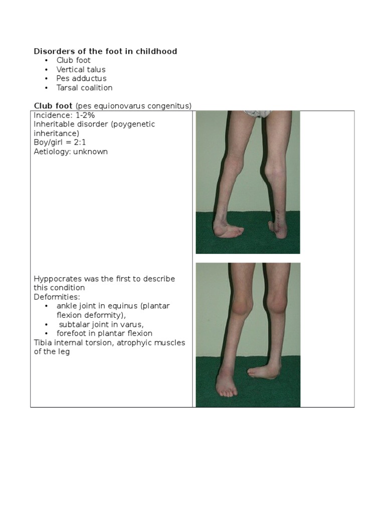 Club Foot Anatomy Ankle Joint | Anatomy.app