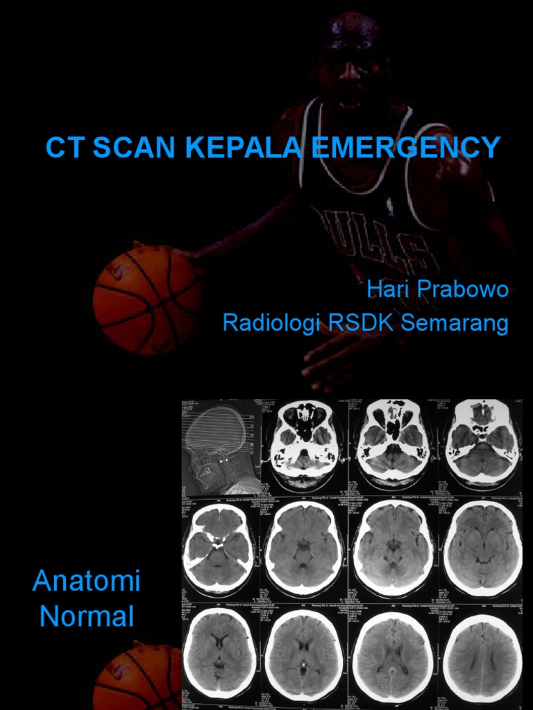 CT Scan Kepala Emergency | PDF