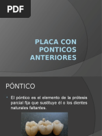 Tipos y funciones del póntico en prótesis fija | PDF | Dentadura ...