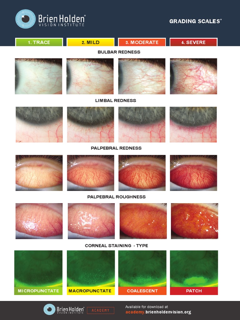 Grading Scale | PDF | Contact Lens | Cornea