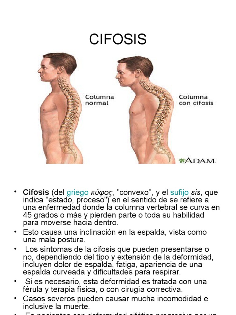 Cifosis | PDF | Especialidades Medicas | Medicina