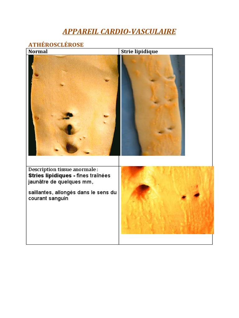 Fiche Anapath Syst Cardio Vasculaire | PDF | Athérome | Maladies ...