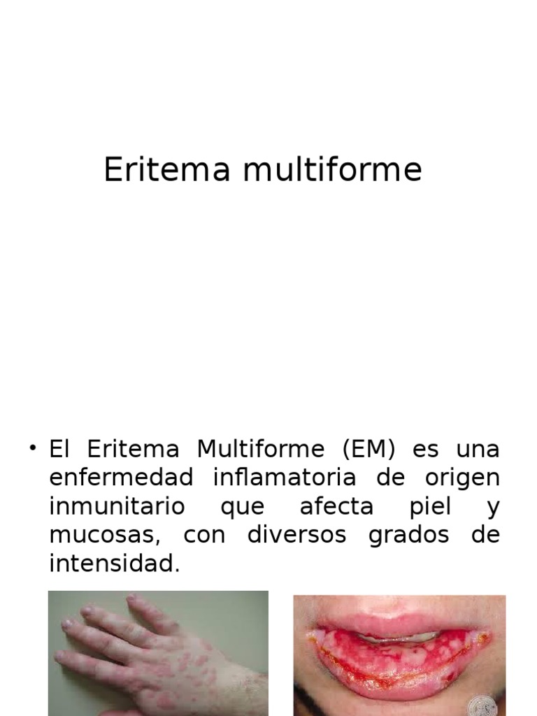 Eritema Multiforme | PDF | Enfermedades y trastornos | Epidemiología