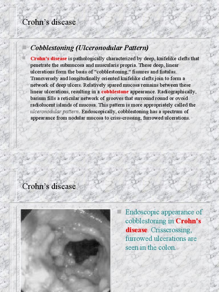 Crohn's Disease: Cobblestoning (Ulceronodular Pattern) | PDF