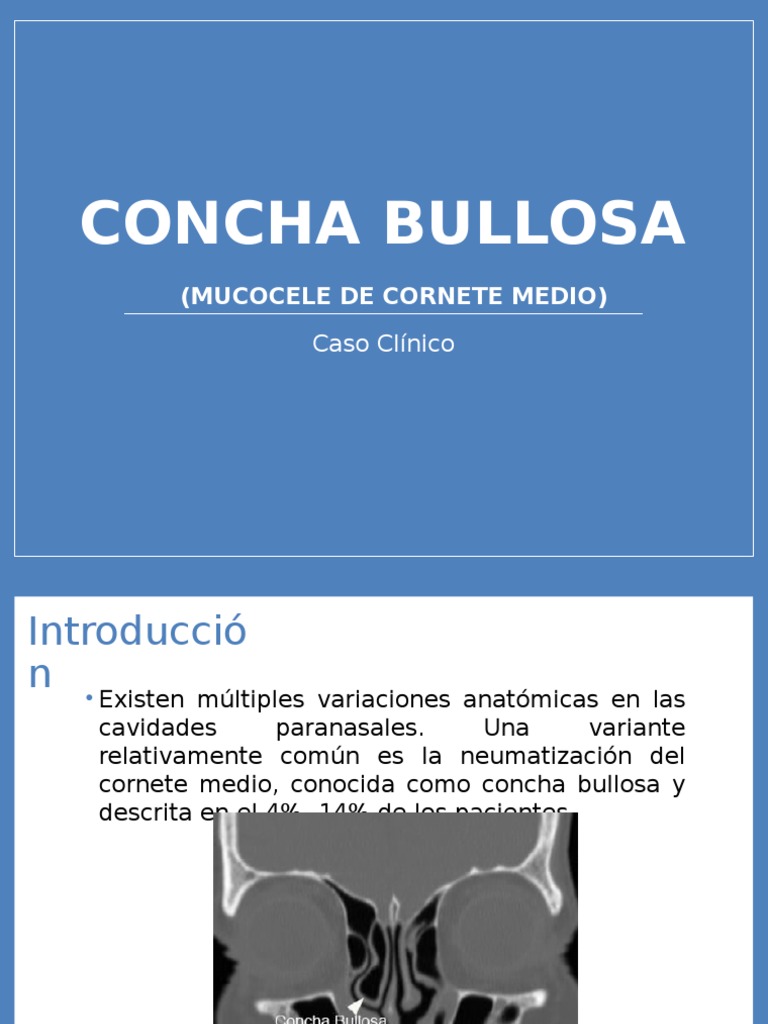 Caso Clinico concha bullosa | Otorrinolaringología | Especialidades Medicas