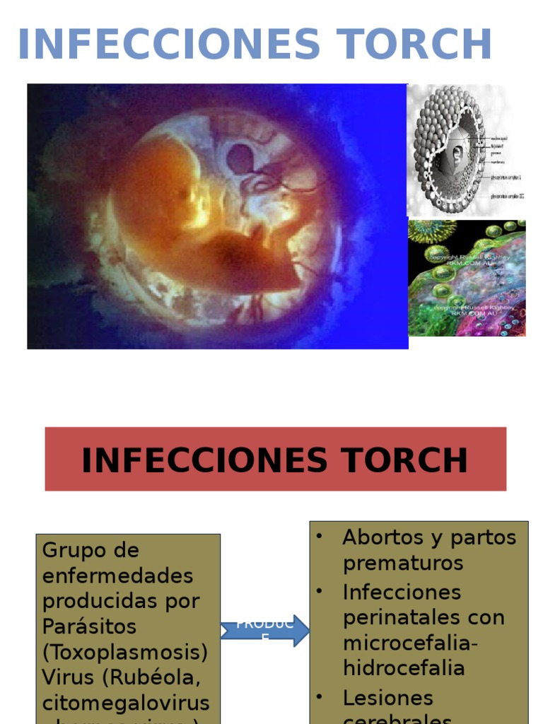 Infecciones Torch | PDF | Especialidades Medicas | Enfermedades y ...