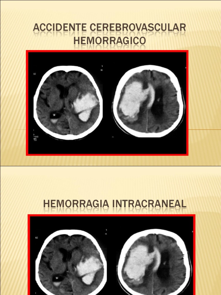 acv hemorragico | Carrera | Enfermedades vasculares