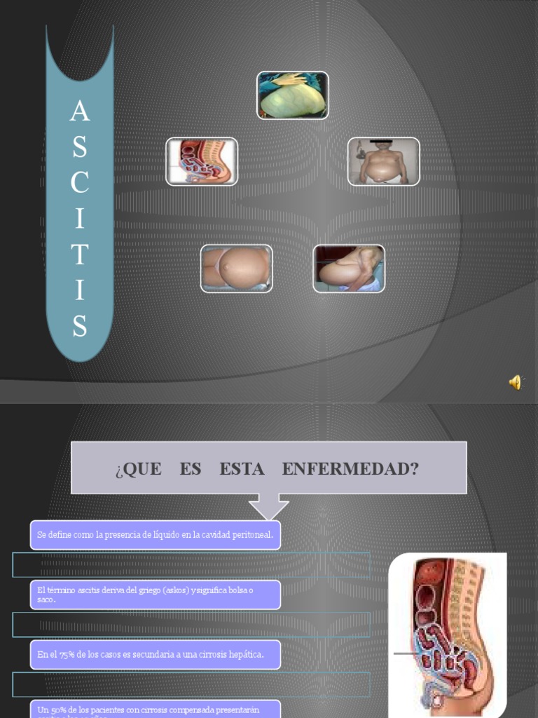 Ascitis | PDF | Especialidades Medicas | Abdomen