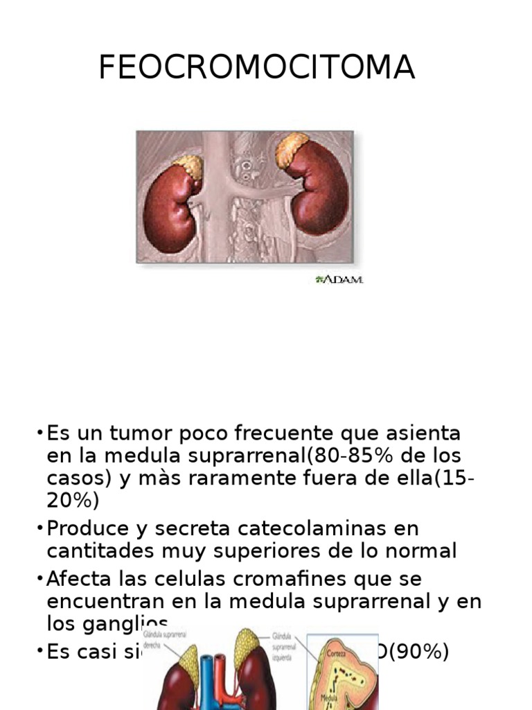 Feocromocitoma | PDF | Epinefrina | Glándula suprarrenal