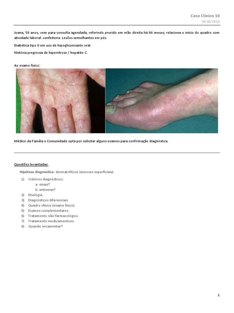 Caso de dermatofitose palmoplantar em paciente diabética: abordagem ...