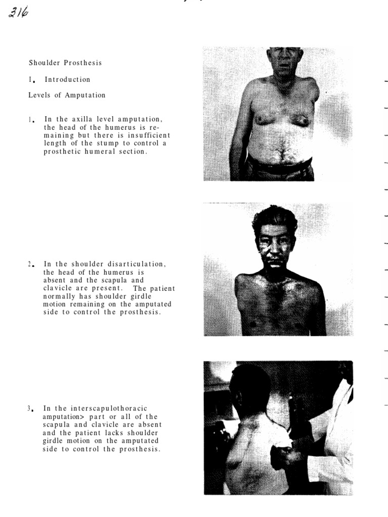 UCLA Upper Extremity Amputations Manual - Sholder Prosthesis | PDF ...