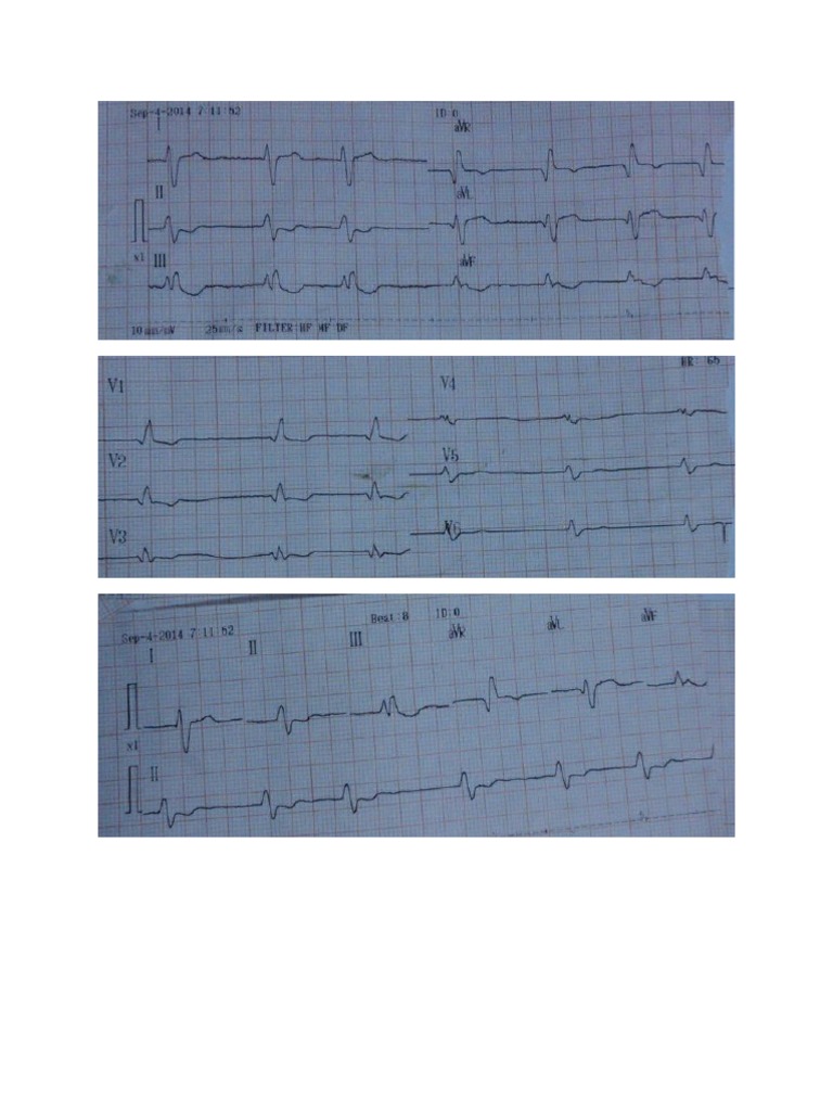 Ekg Omi | PDF