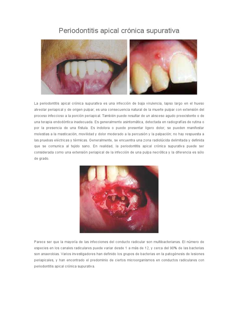 Periodontitis Apical Crónica Supurativa | Infección | Salud pública