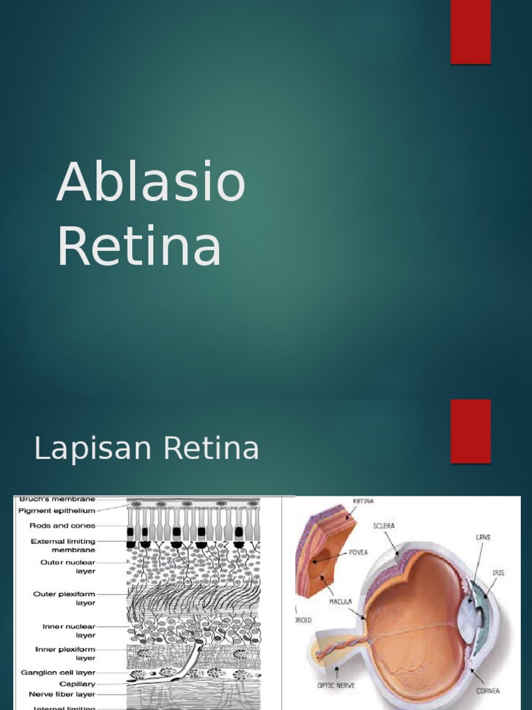 Ablasio Retina | PDF
