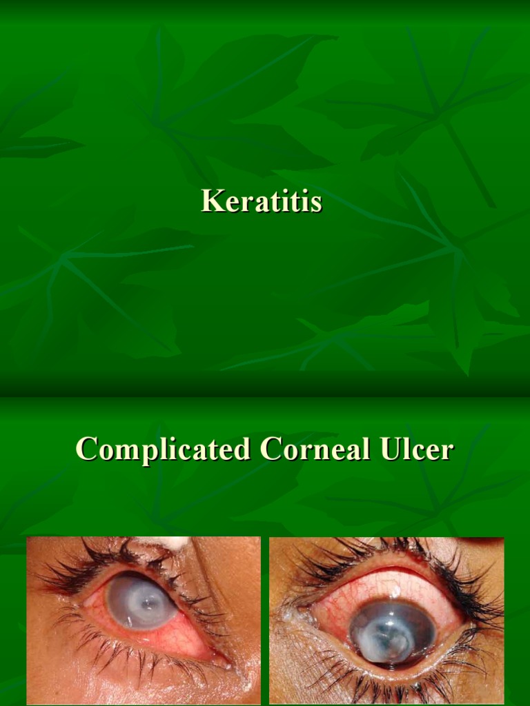 Keratitis | Cornea | Ophthalmology