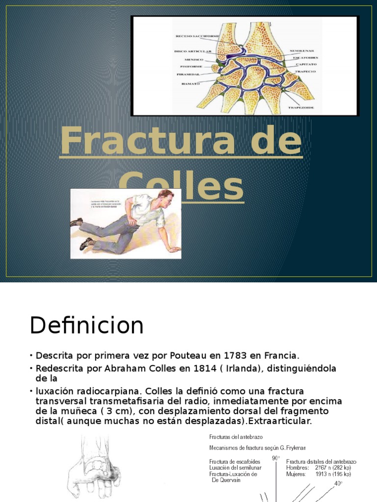 Fractura de Colles | PDF | Síndrome del túnel carpiano | Mano