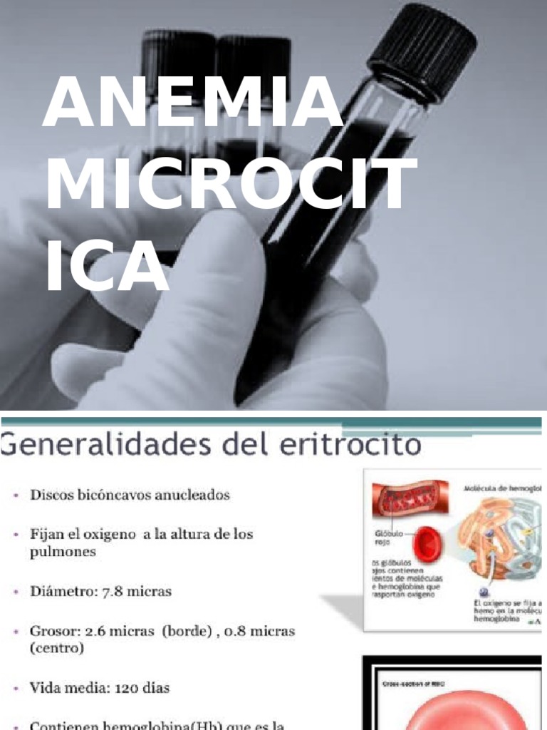 Anemia MicroCitiCA | PDF | Anemia | Hematología