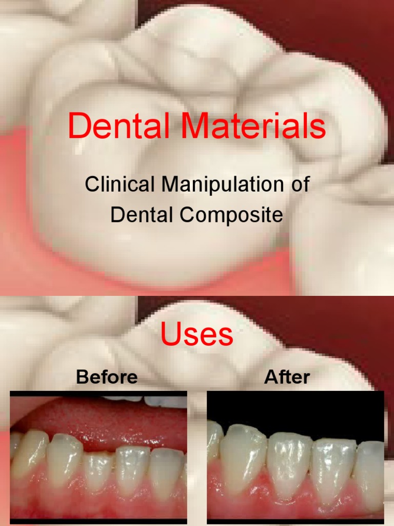 Dental Materials: Clinical Manipulation of Dental Composite | PDF