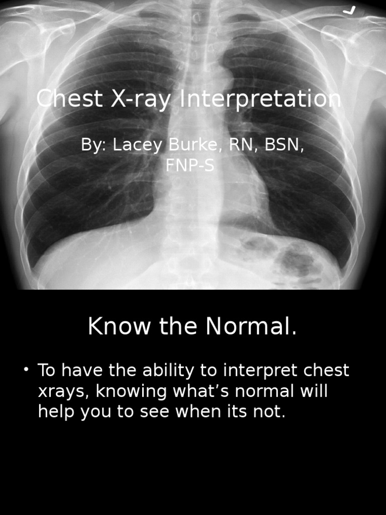 Chest X-ray Interpretation Guide | PDF | Lung | Atrium (Heart)