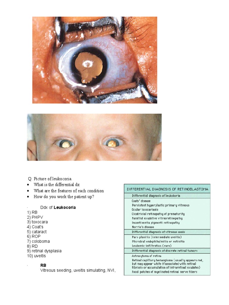Leukocoria | Medicine | Diseases And Disorders