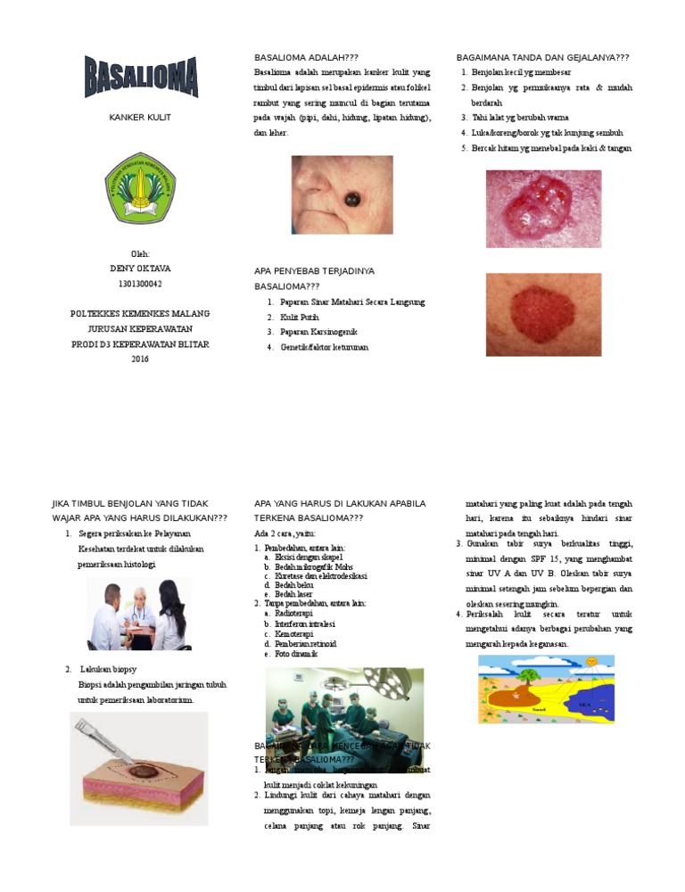 Leaflet Basalioma (Kanker Kulit) | PDF | Griya & Taman | Kesehatan Holistik