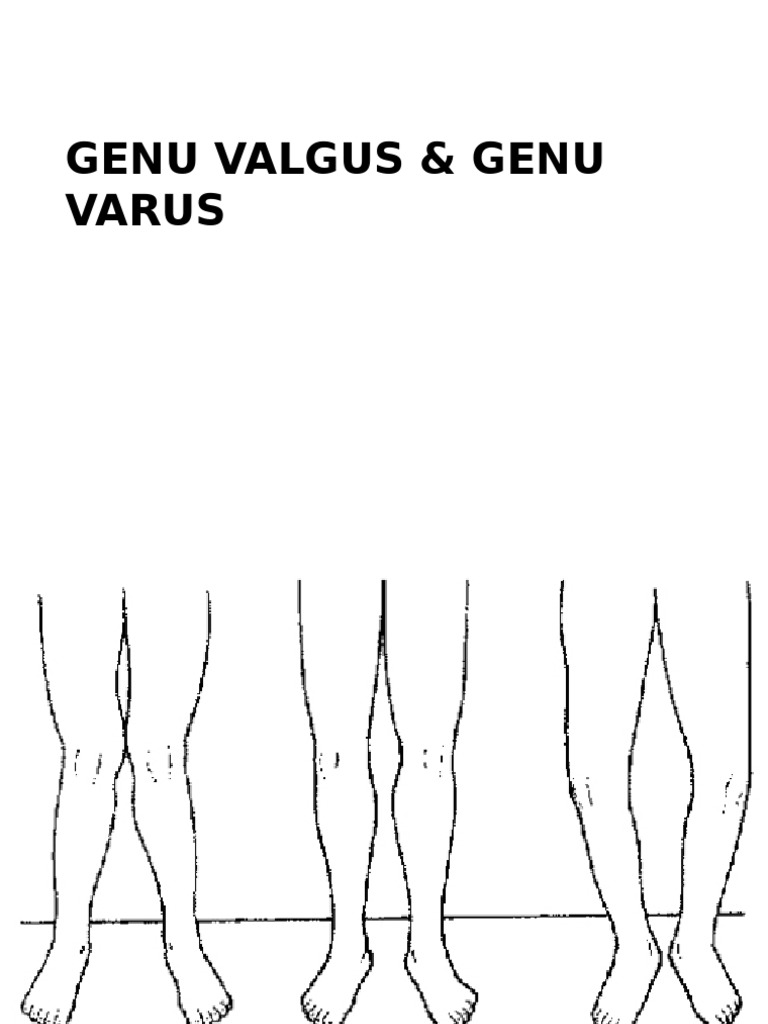 Genu Valgus & Genu Varus | Foot | Musculoskeletal System