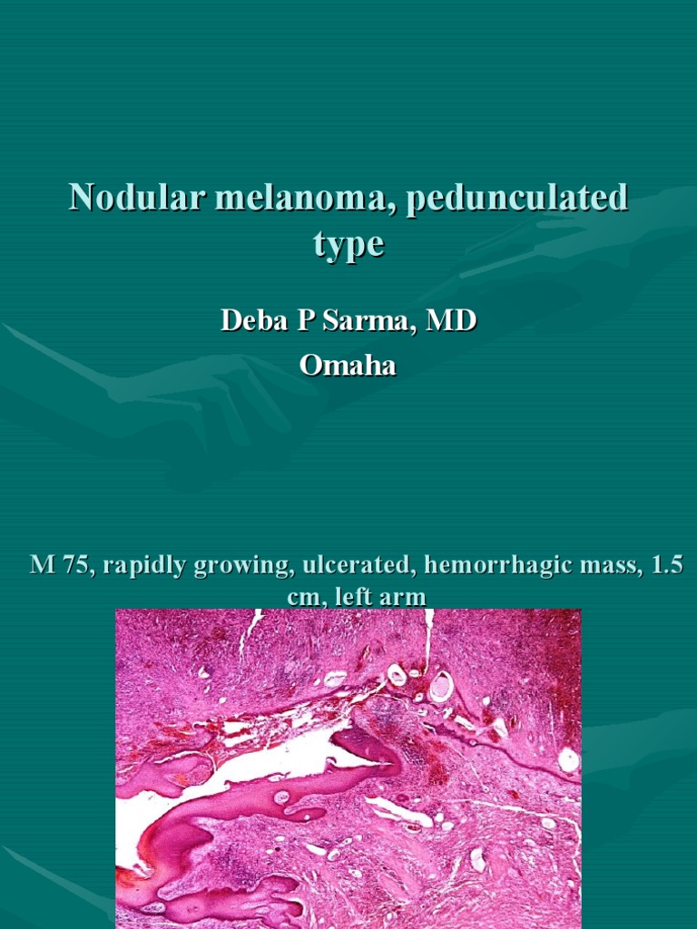 Nodular Melanoma, Pedunculated Type | PDF