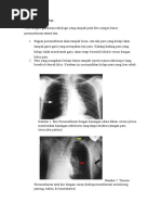 Anatomi Thorax Normal + Gambaran Radiologi | PDF