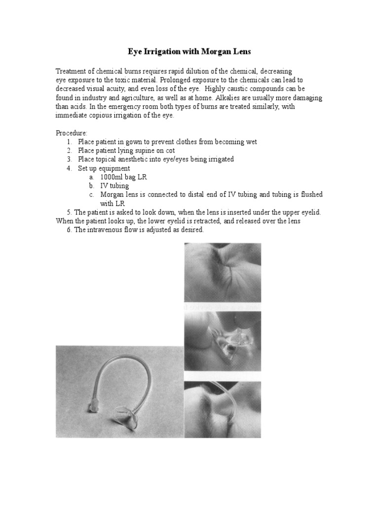 Eye Irrigation Procedure Guide | PDF | Self-Improvement | Wellness