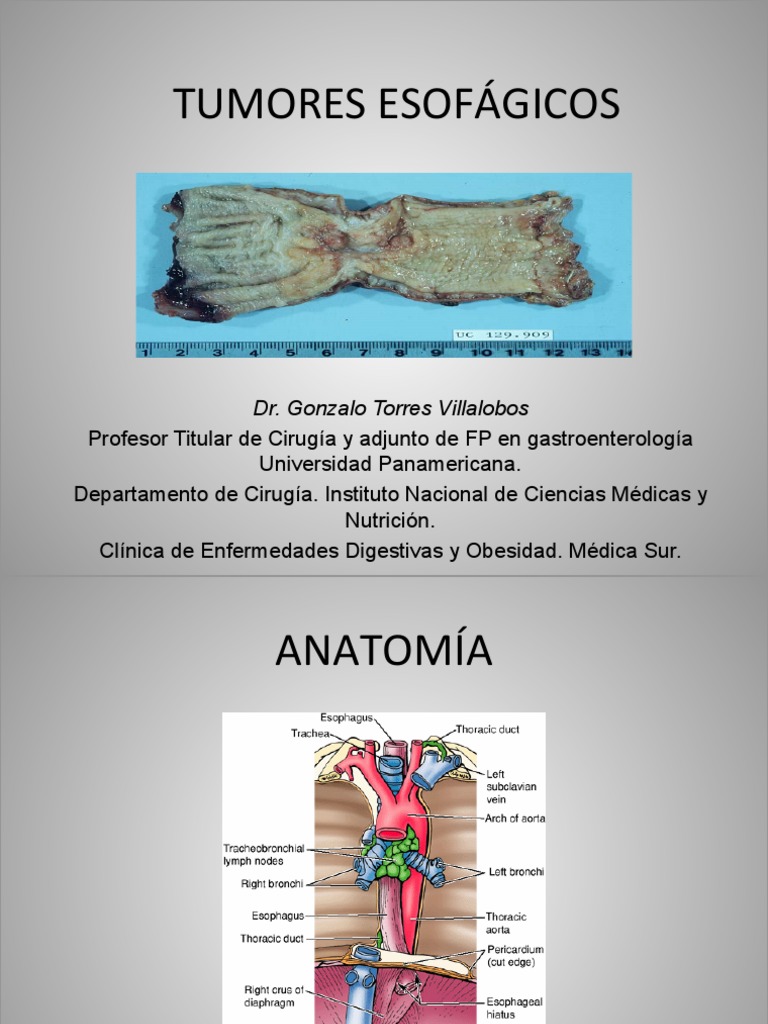 Gastro - Tumores Esofágicos | Cáncer de esófago | Metástasis