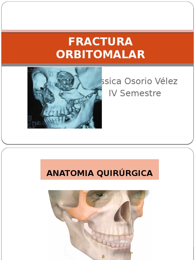 Fractura Orbitomalar | PDF | Anatomía humana | Anatomia animal