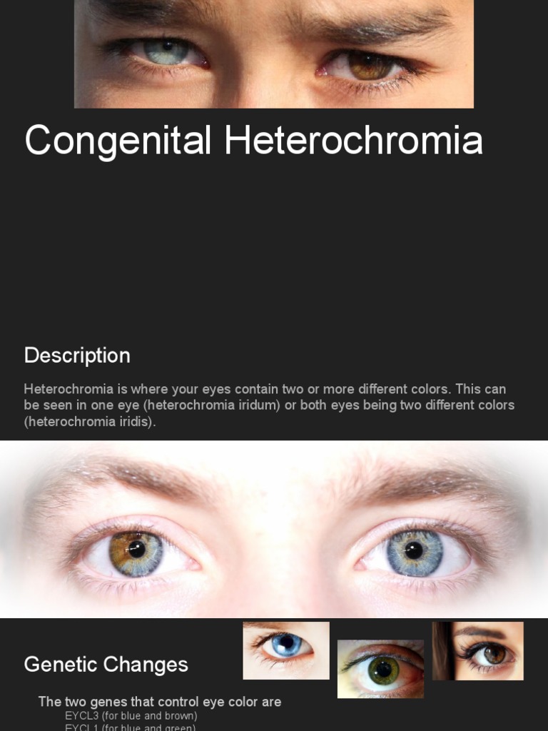 Congenital Heterochromia | PDF