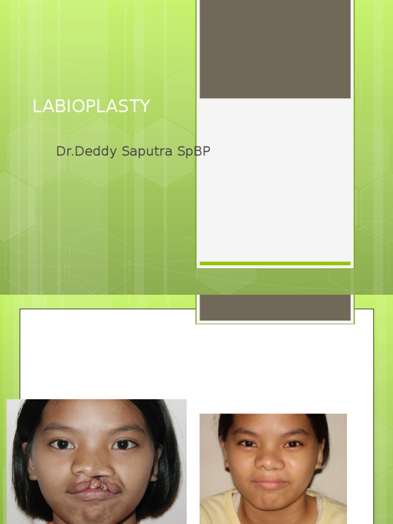 Labioplasty | PDF