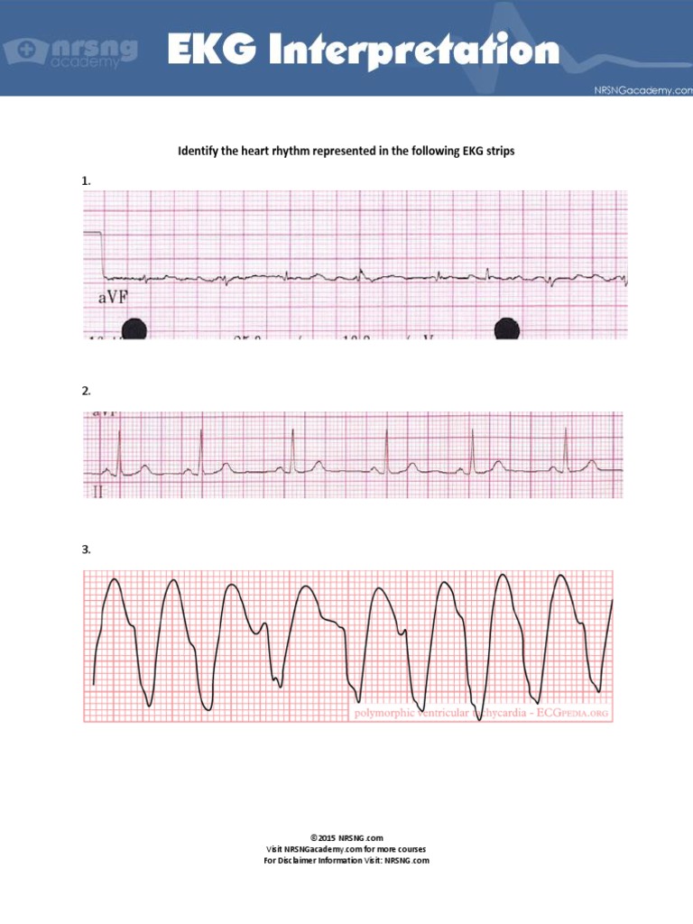 Identify The Heart Rhythm Represented in The Following EKG Strips | PDF