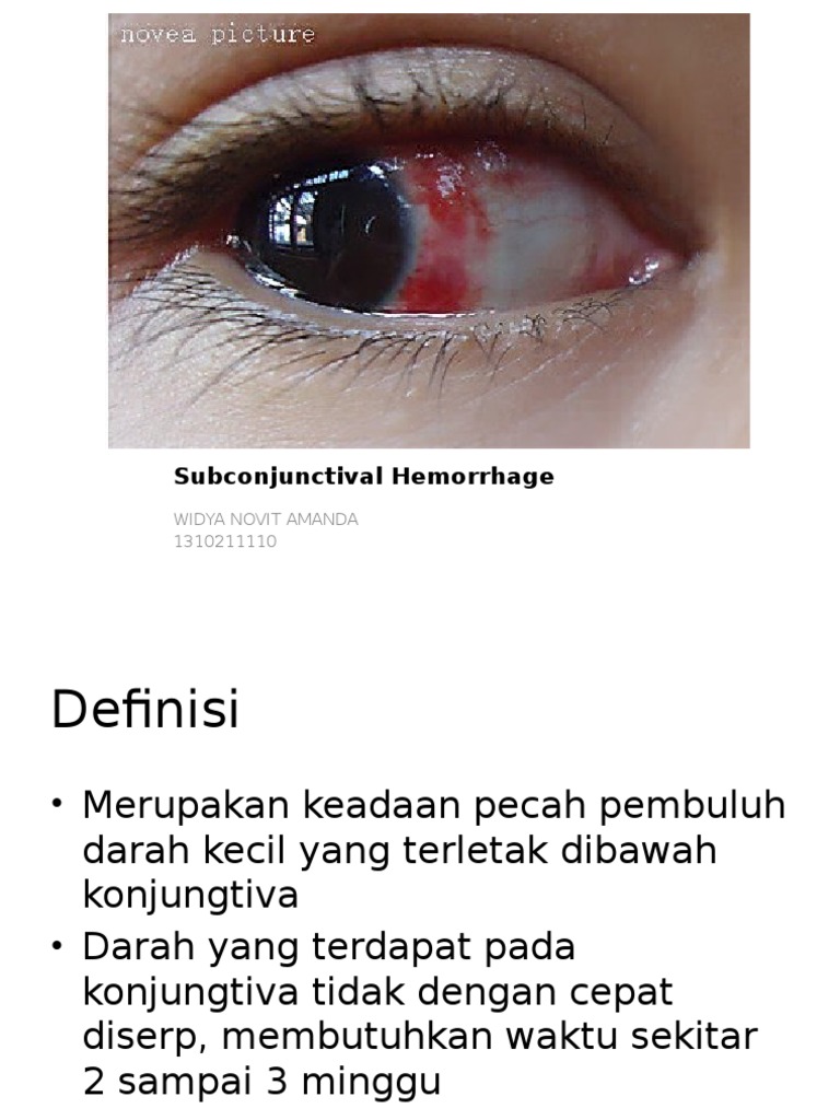 Subconjunctival Hemorrhage | PDF