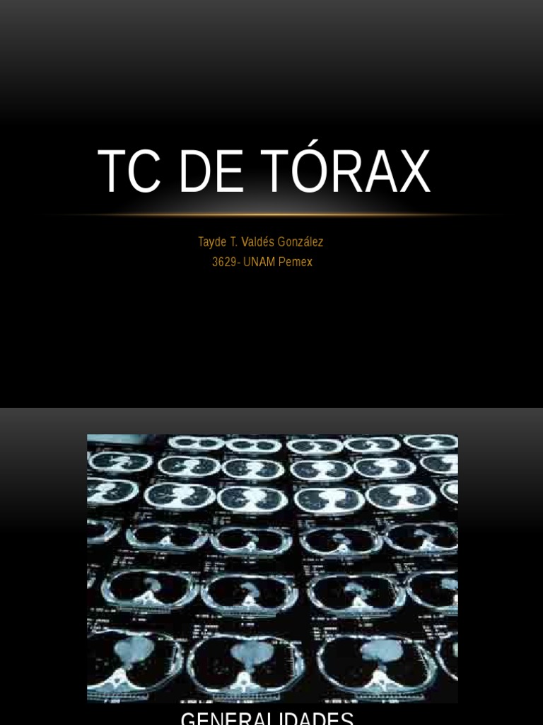 TC Torax | PDF | Ct Scan | Pulmón